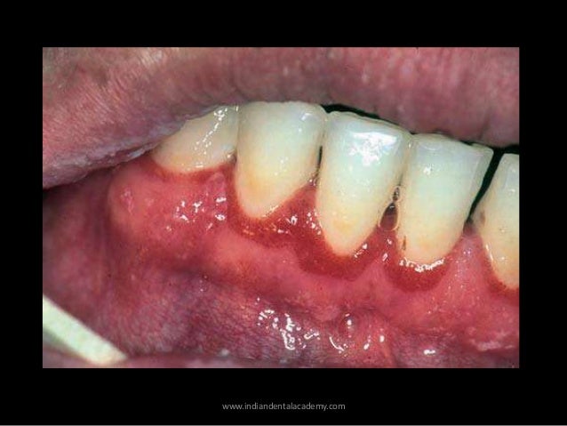 Oral manifestations of hiv aids/ dental implant courses
