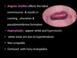 Angular Cheilitis Hiv