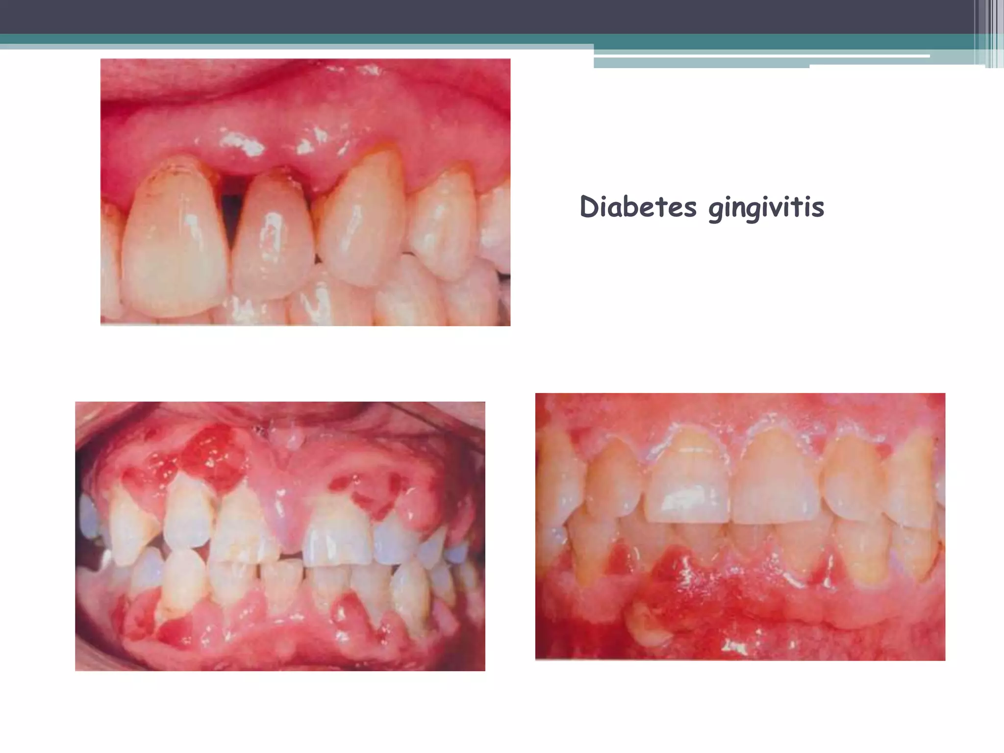 Oral manifestations of nutritional deficiencies | PPTX