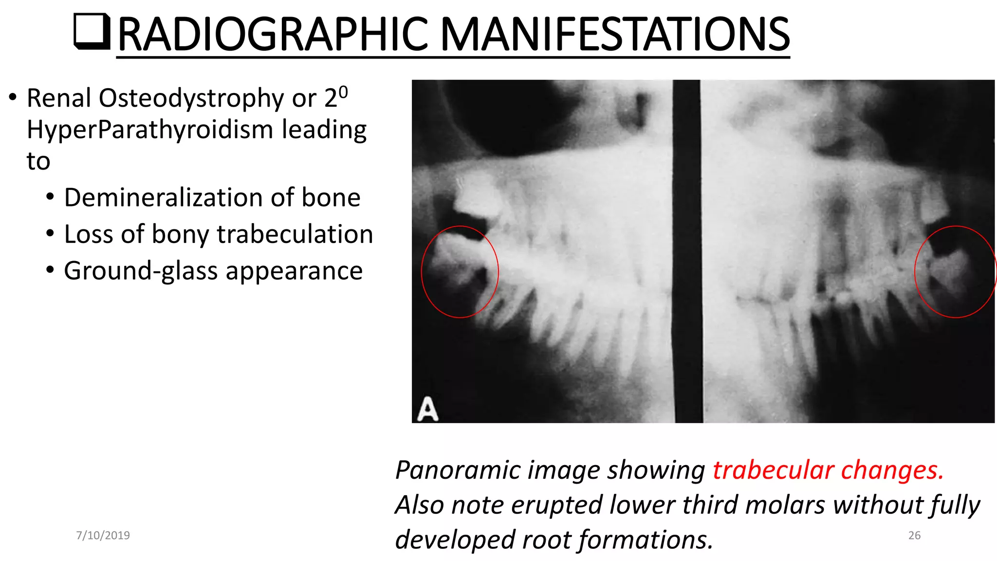 Oral manifestations of renal diseases | PPTX