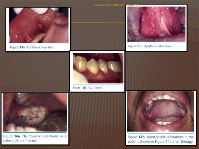 Oral Manifestations Of Sexually Transmitted Diseases Dental Courses Ppt