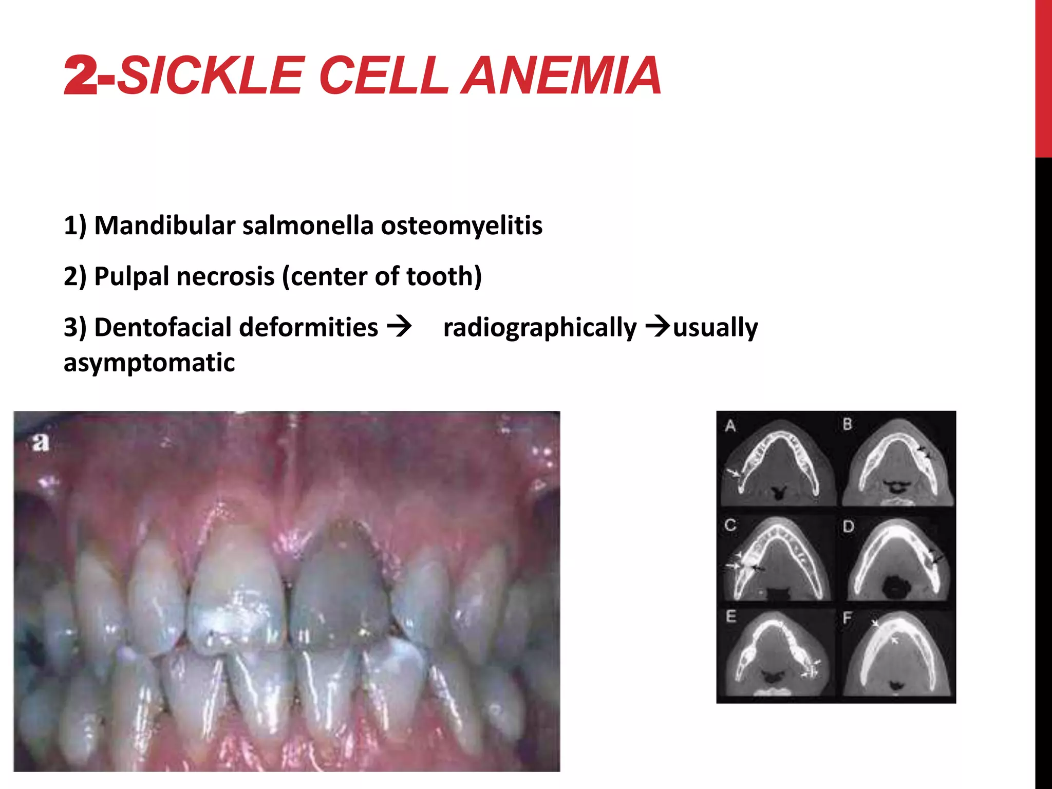 Oral manifestations of systemic disease | PPTX