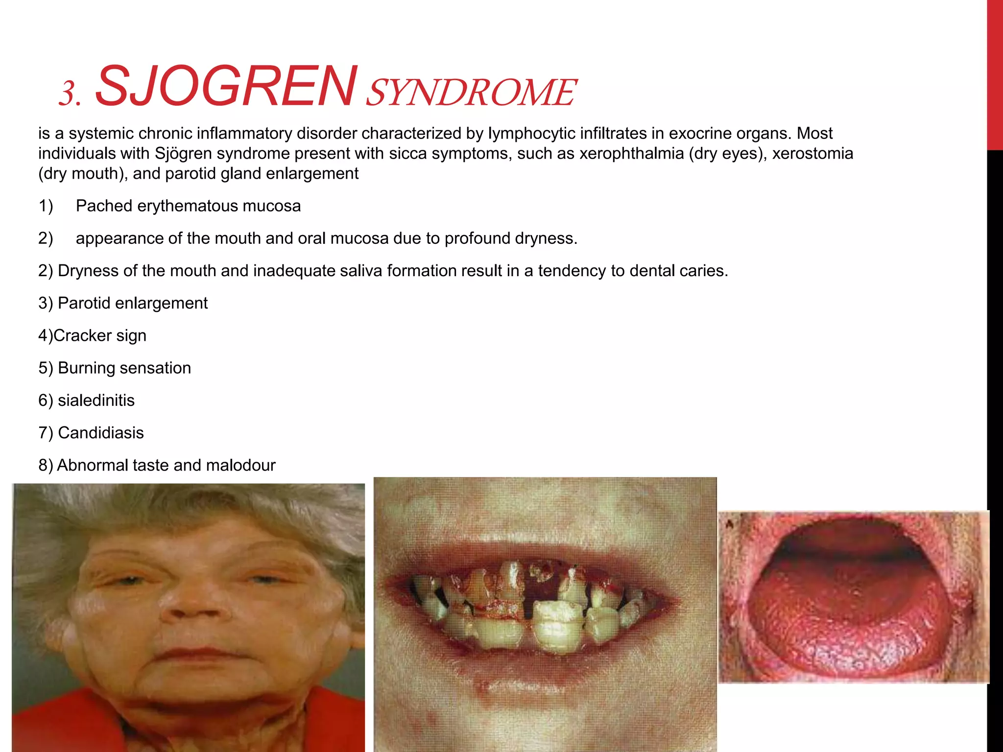 Oral manifestations of systemic disease | PPTX