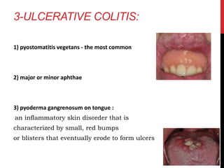 Pyostomatitis Gangrenosum