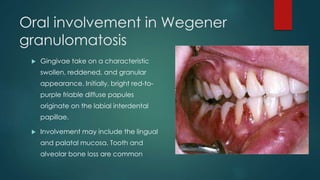 Oral manifestations of systemic diseases | PPTX