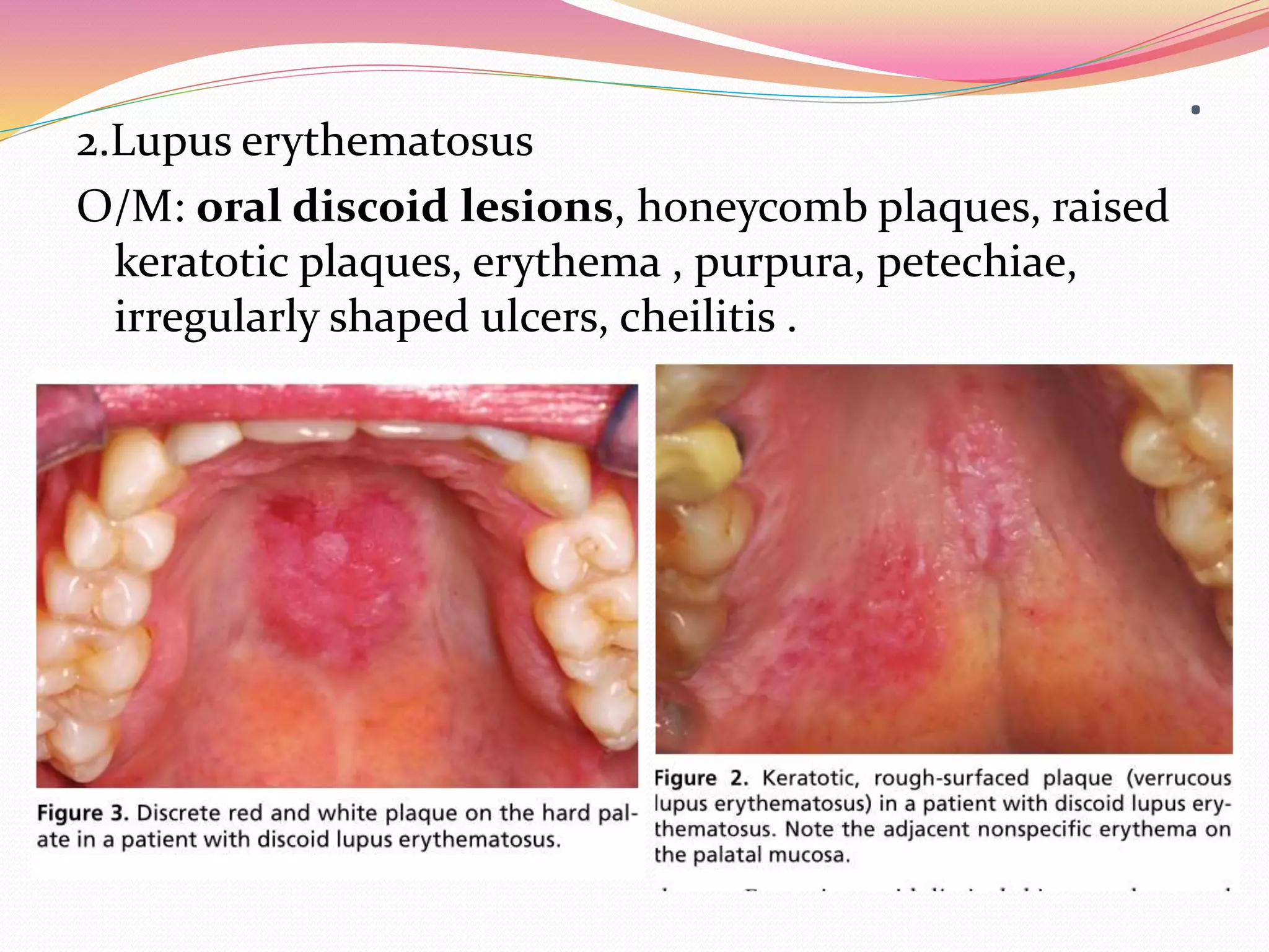 Oral Manifestations Of Systemic Diseases Pptx