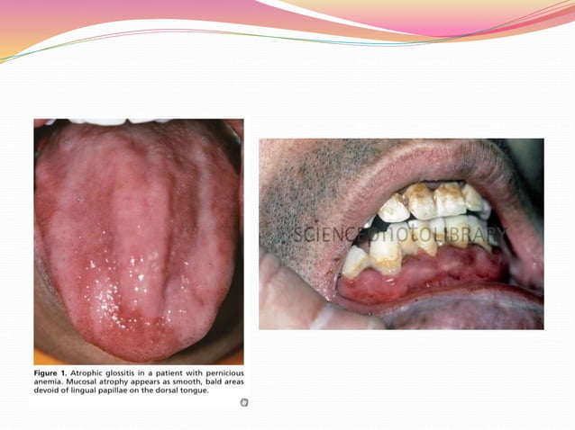Oral manifestations of systemic diseases | PPTX