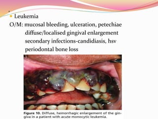 Oral manifestations of systemic diseases | PPTX