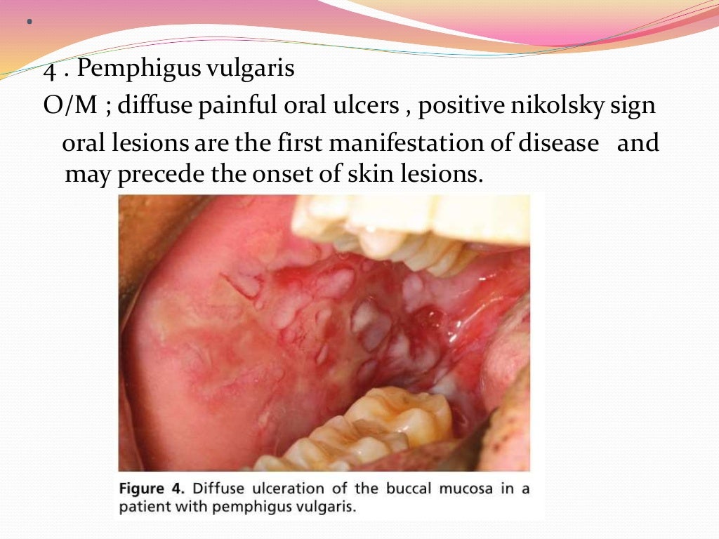 Oral Manifestations Of Systemic Diseases