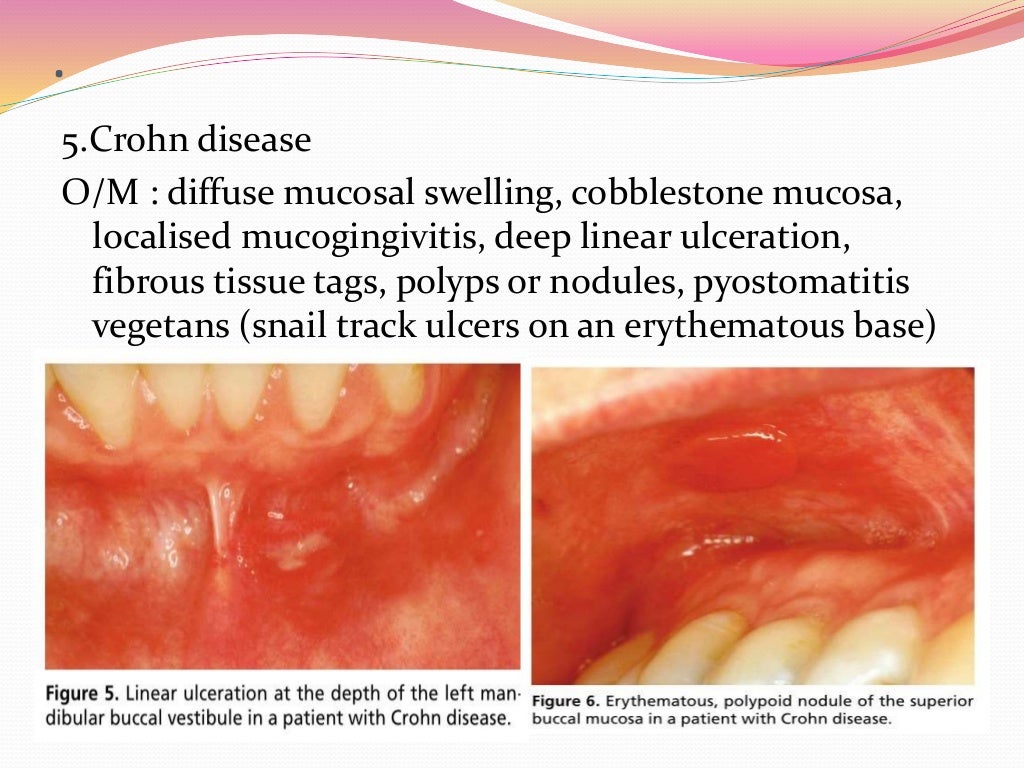 Oral Manifestations Of Systemic Diseases