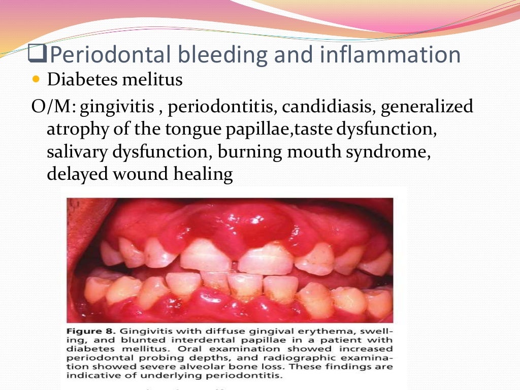 Oral Manifestations Of Systemic Diseases