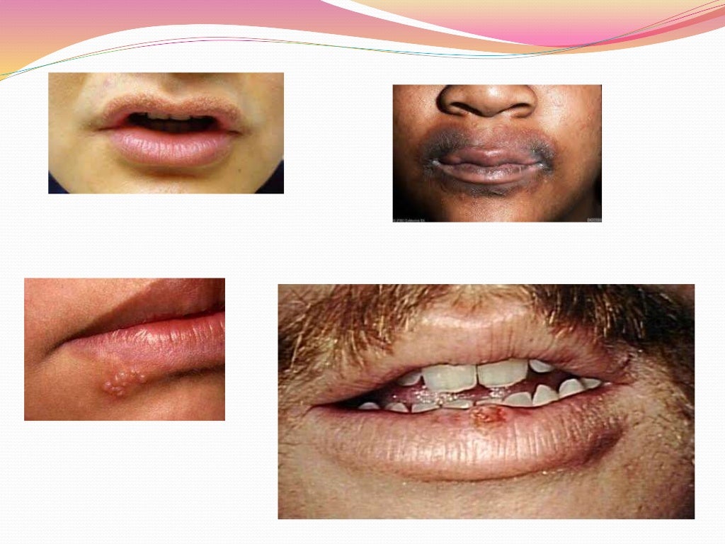 Oral Manifestations Of Systemic Diseases