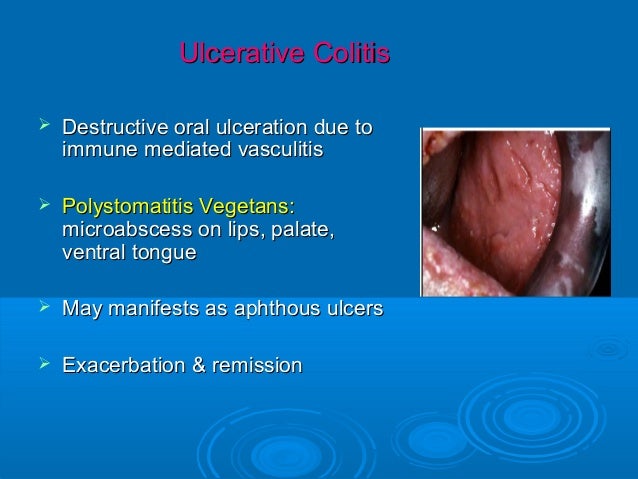 Oral manifestations of systemic diseases