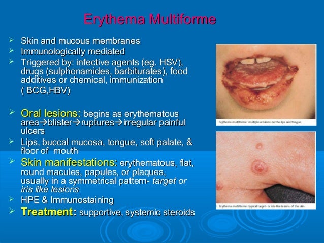 Oral manifestations of systemic diseases