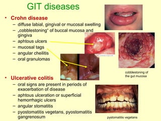 Oral manifestations of systemic diseases | PPT