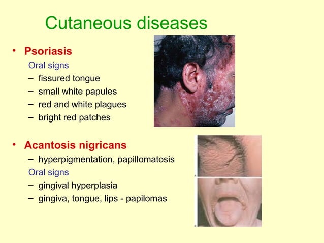 Oral manifestations of systemic diseases