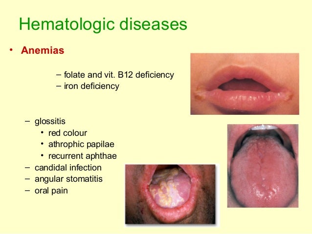 Oral manifestations of systemic diseases