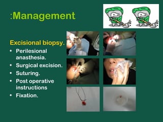 Oral medicine case(fibro-epithelial polyp) | PPT