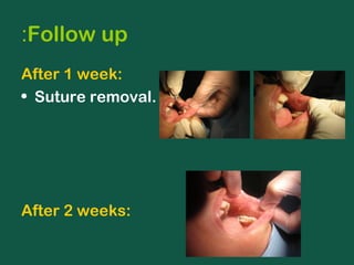 Oral medicine case(fibro-epithelial polyp) | PPT