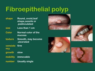 Fibroepithelial Polyp