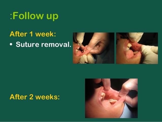 Oral medicine case(fibro-epithelial polyp)