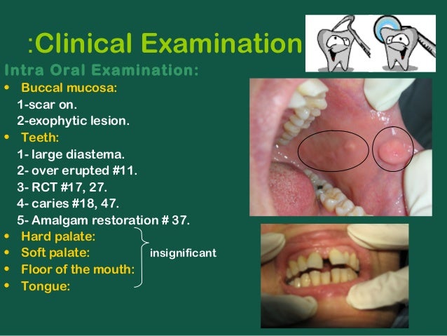 Oral medicine case(fibro-epithelial polyp)