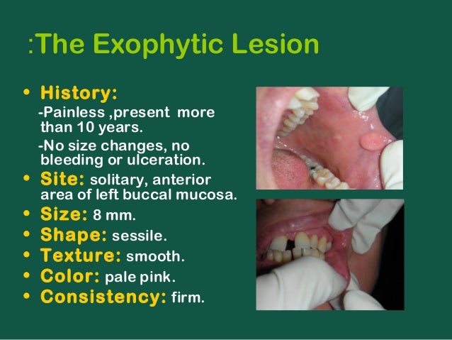 Oral medicine case(fibro-epithelial polyp)