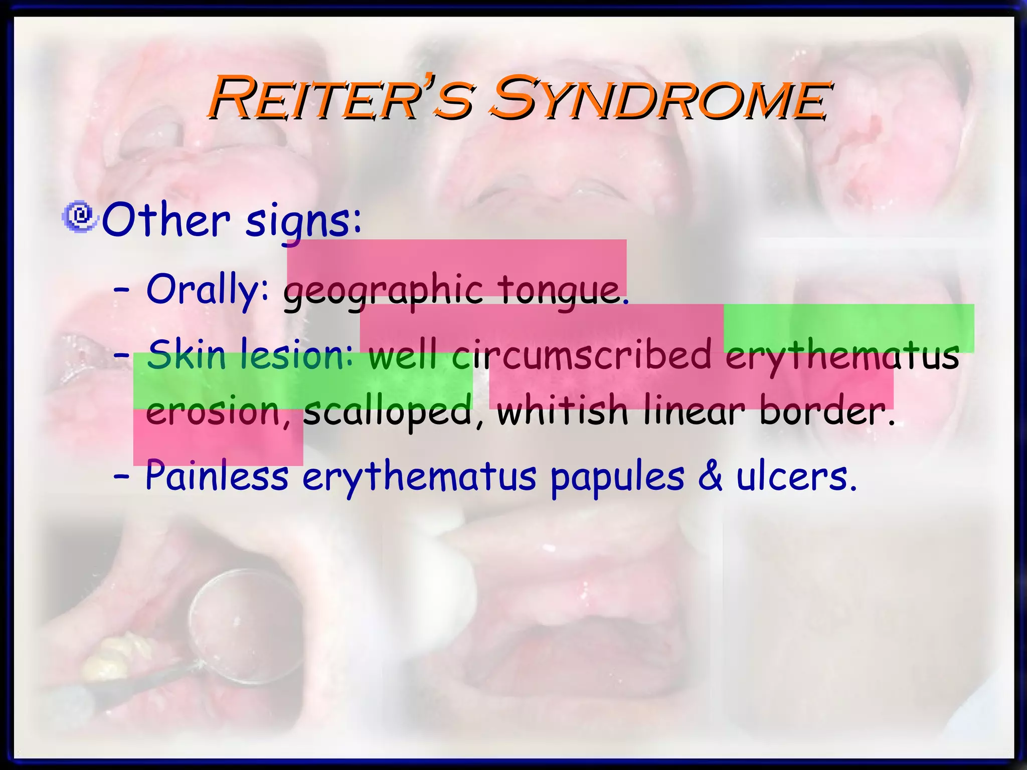 Oral medicine case behcet disease | PPT