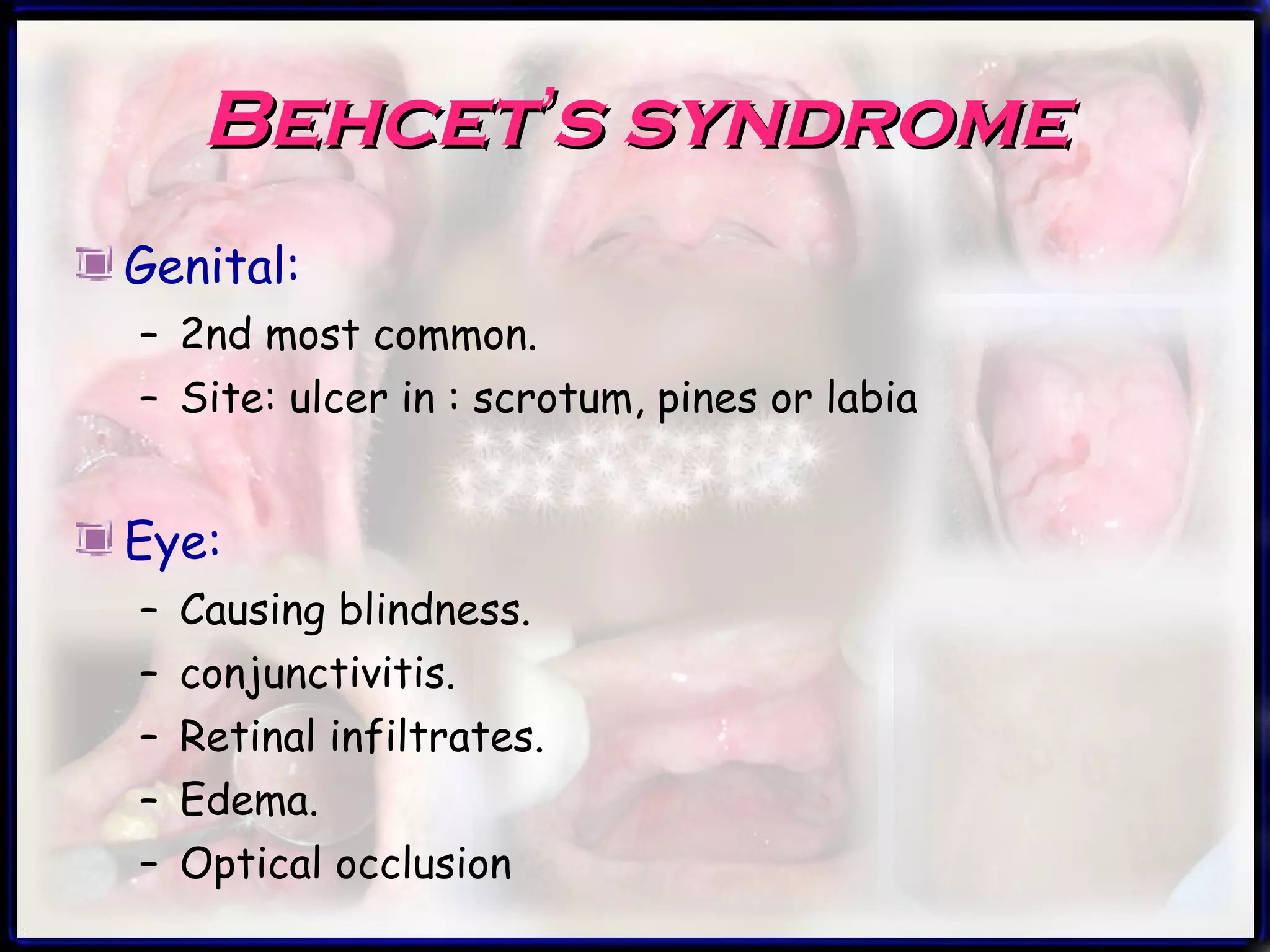 Oral medicine case behcet disease | PPT