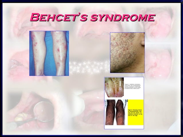 Oral medicine case behcet disease