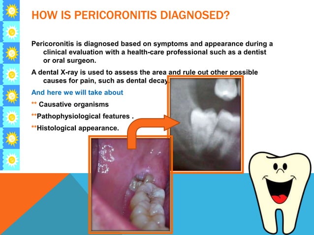 pericoronitis(RR)