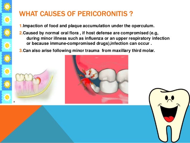 pericoronitis(RR)