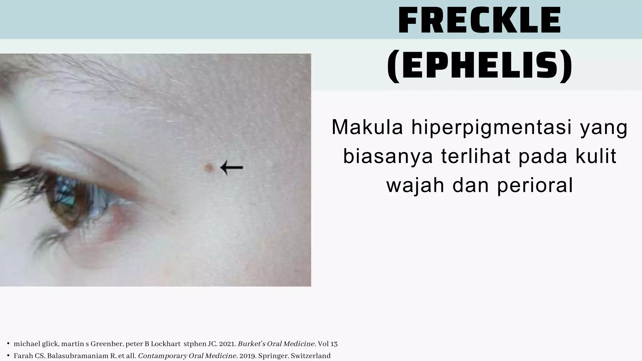 Oral Melanotic Macule-3.pptx