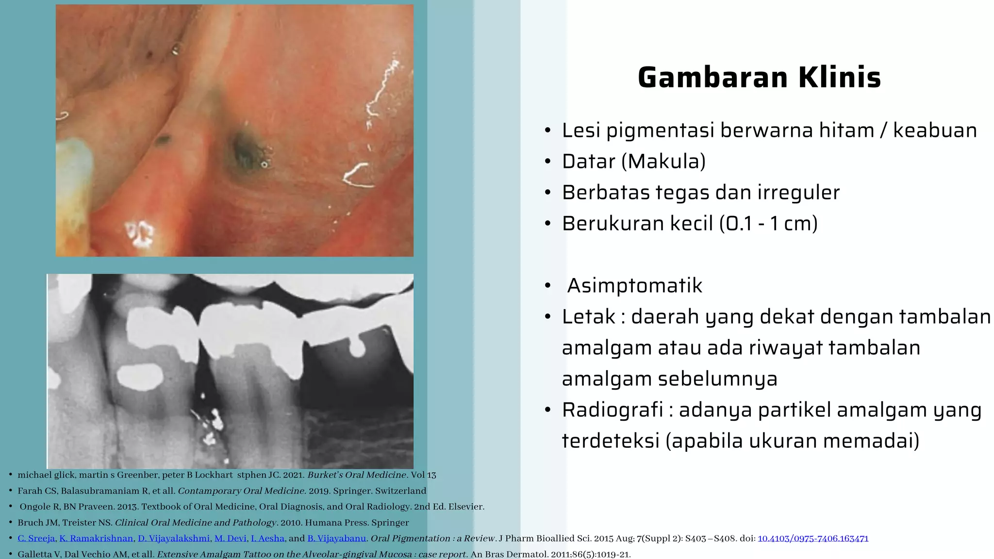 Oral Melanotic Macule-3.pptx