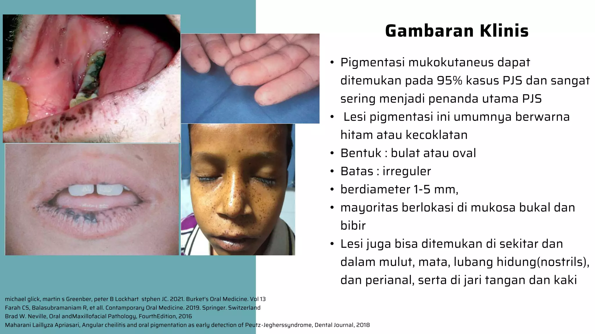 Oral Melanotic Macule-3.pptx