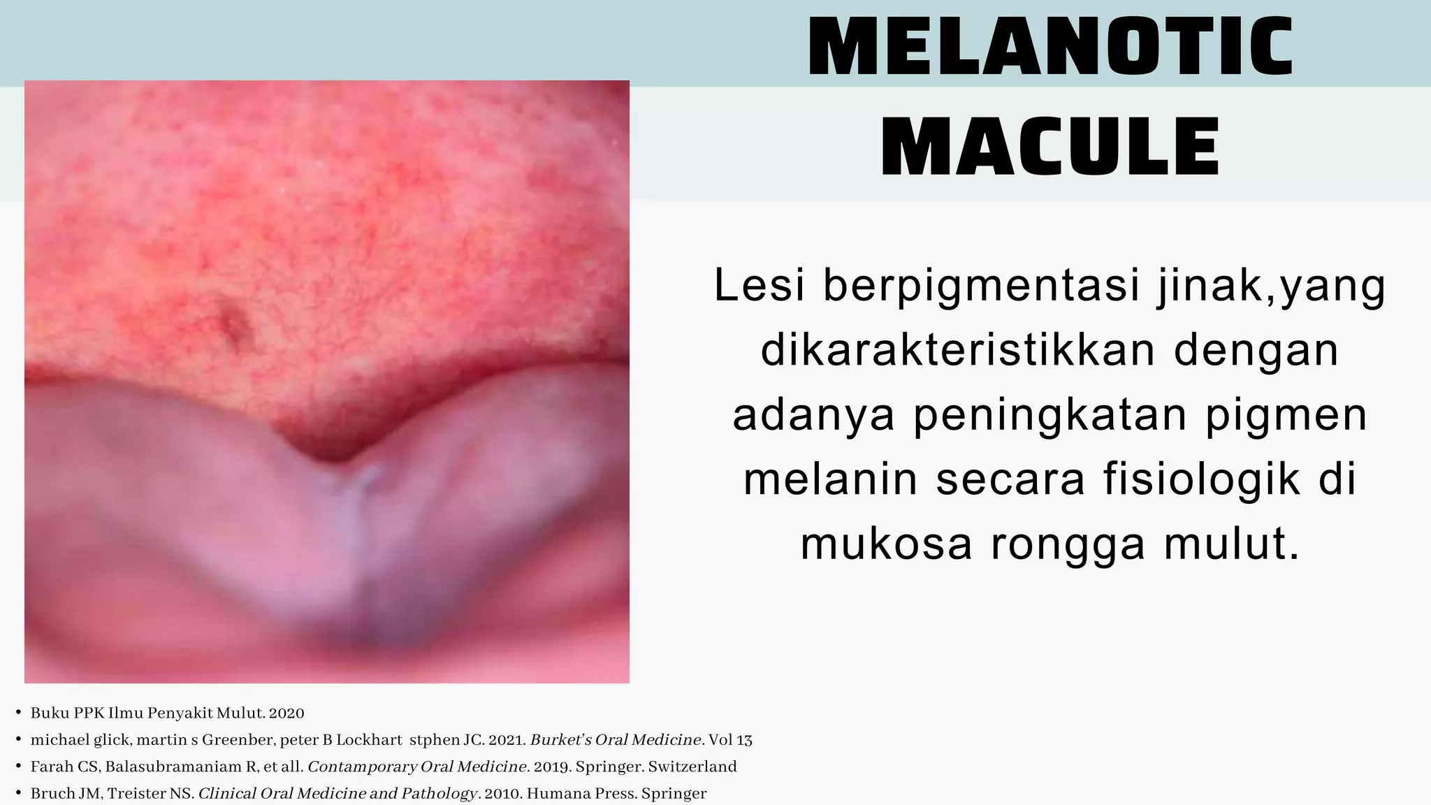 Oral Melanotic Macule-3.pptx