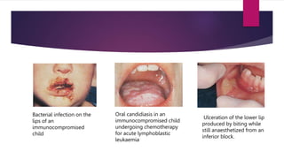 Strecture of oral mucosa in children.pptx