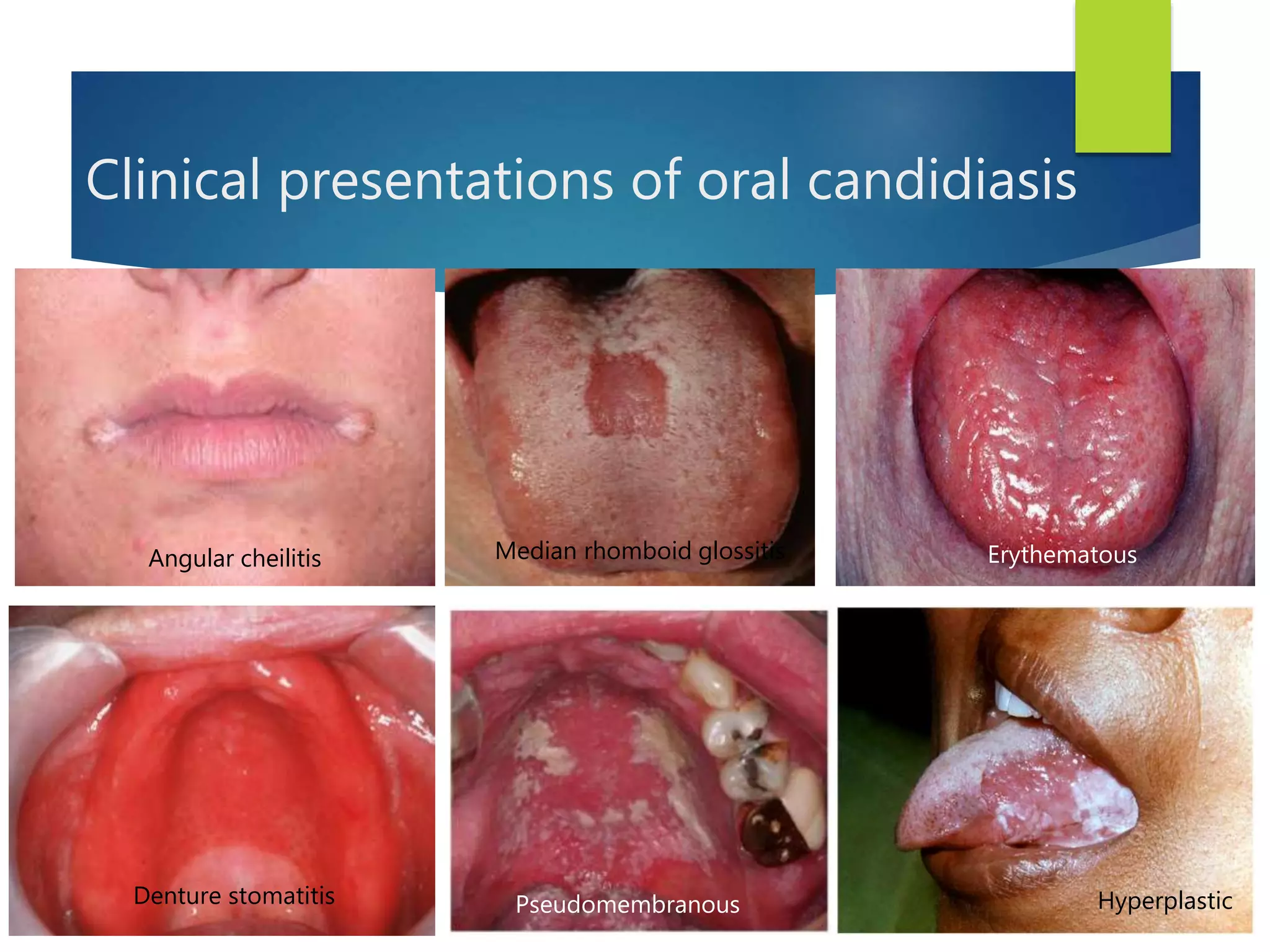 Oral mucosal lesions | PPTX