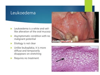 Leukoedema Histology