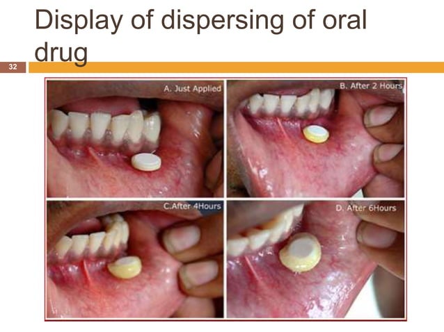 Oral mucosal drug delivery systems | PPTX