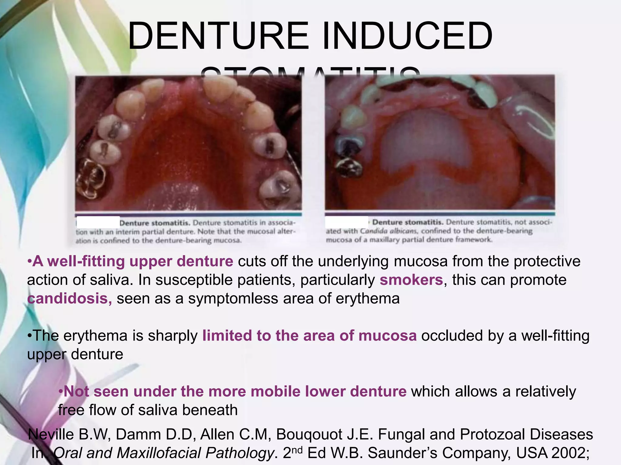 Oral mucosal lesions in denture wearers | PPTX