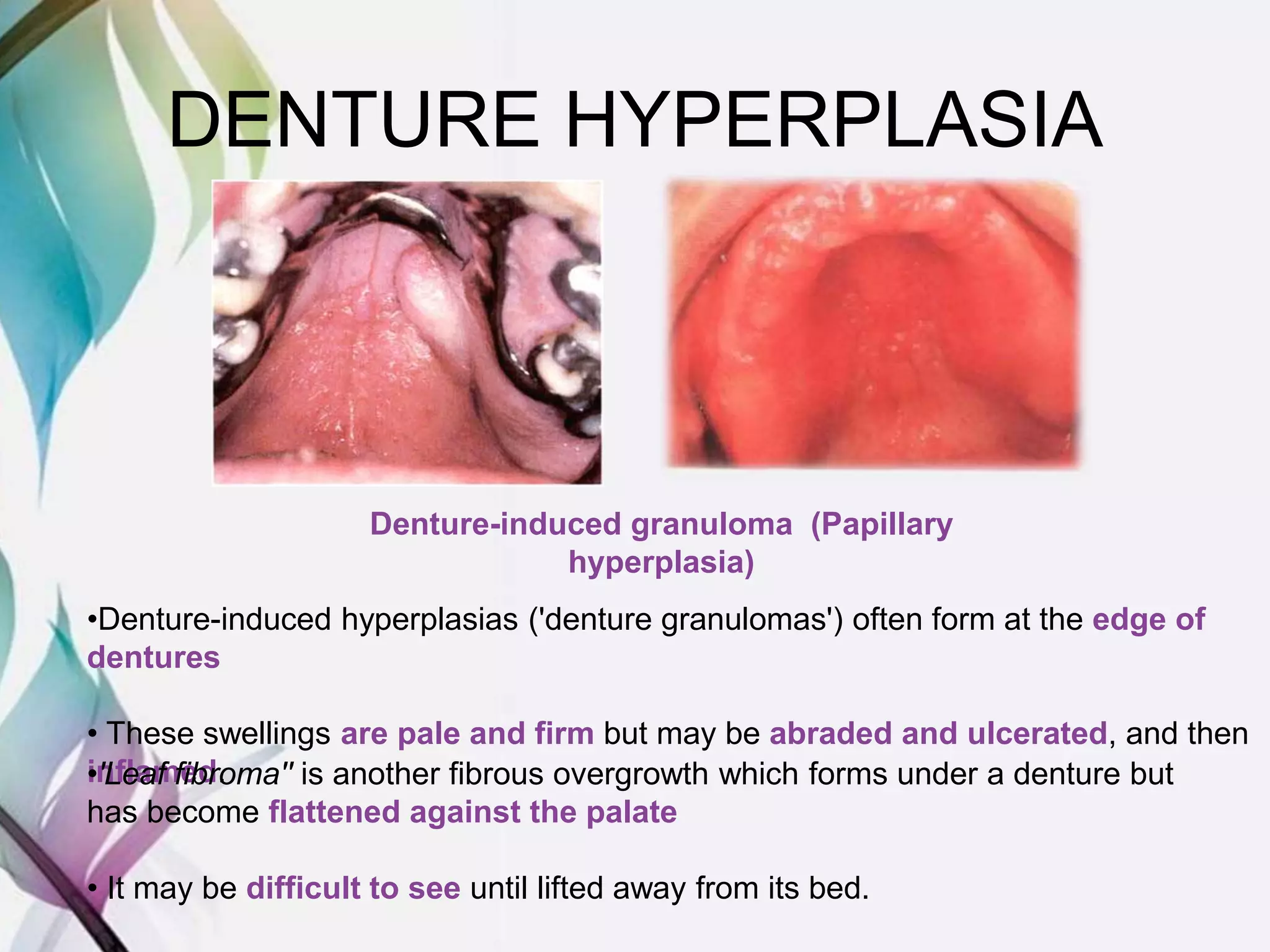 Oral mucosal lesions in denture wearers | PPTX