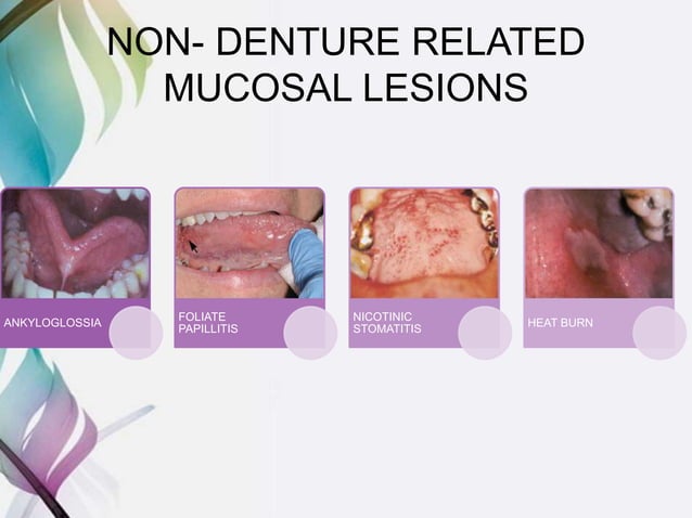 Oral mucosal lesions in denture wearers | PPTX