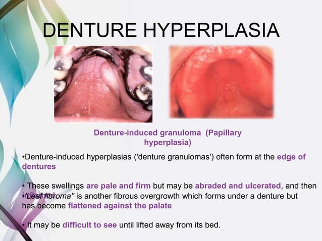 Oral mucosal lesions in denture wearers | PPTX