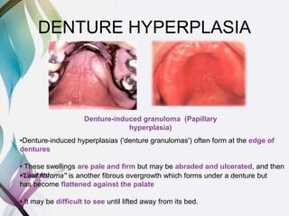 Denture Induced Fibrous Hyperplasia