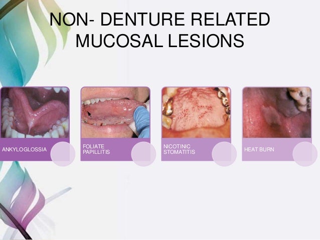 Oral mucosal lesions in denture wearers