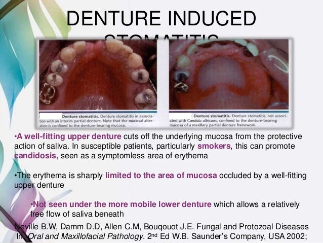 Oral mucosal lesions in denture wearers