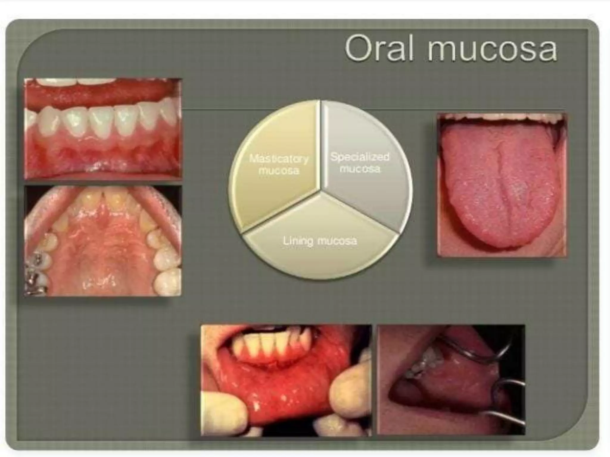 Oral mucosal ulceration | PPT