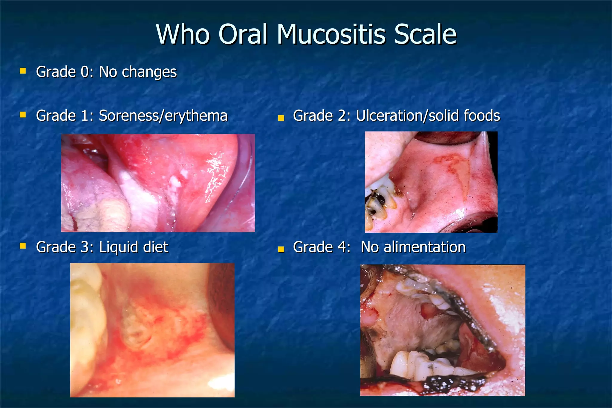 Oral Mucositis In Cancer Care | PPT