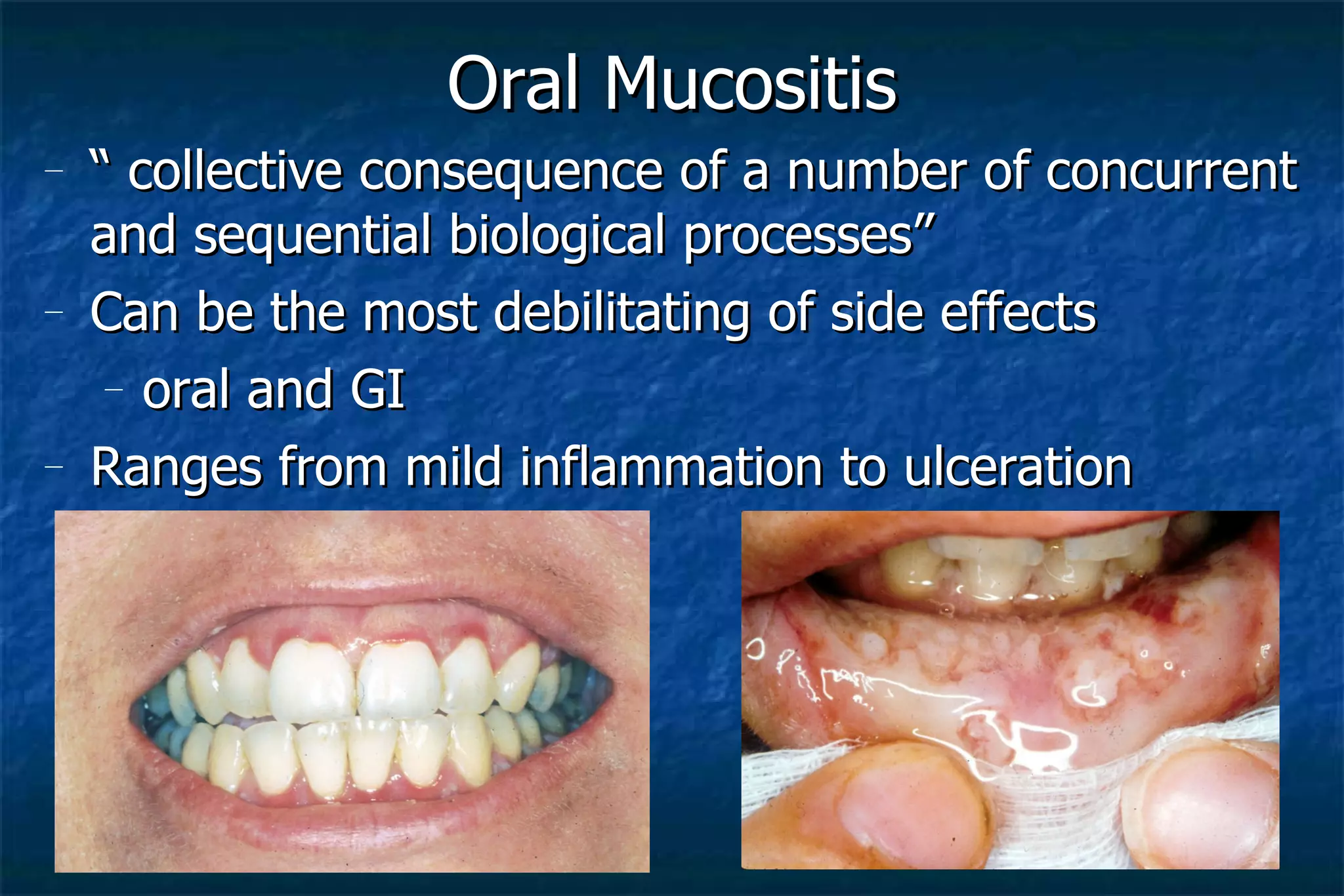Oral Mucositis In Cancer Care Is The End In Sight | PPT